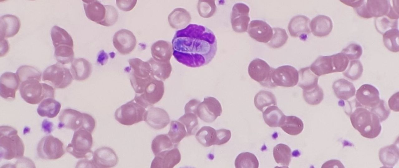 [Webinar] Hematology Part 2: Microscopic blood cell identification ...